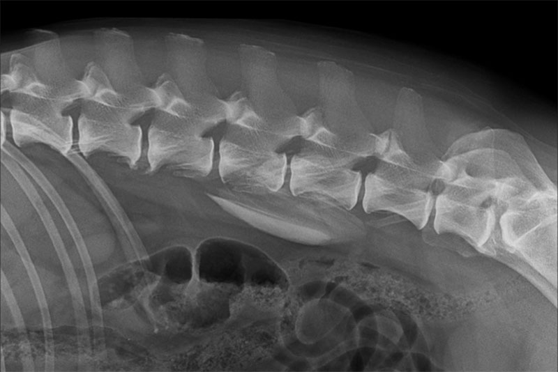 Psoas Compartment Block