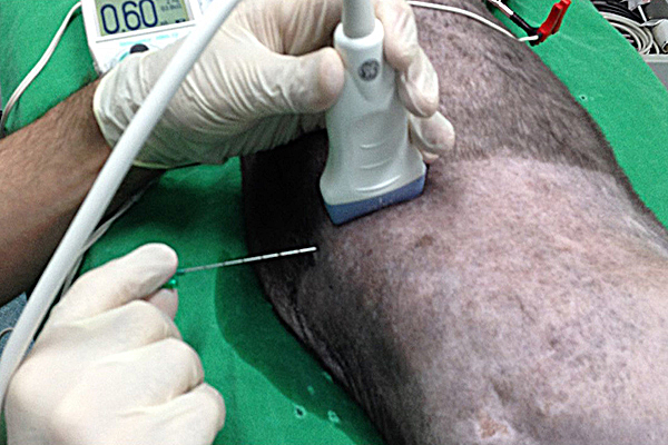 Psoas Compartment Block
