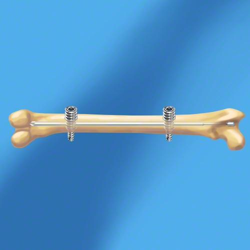 Products Traumatology